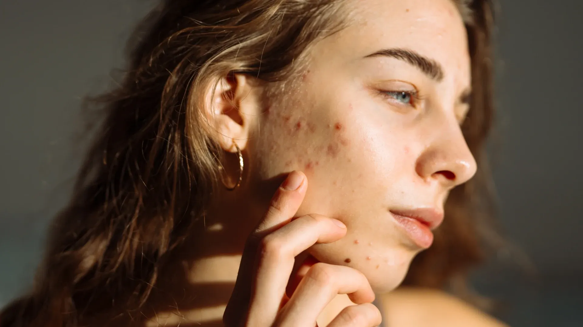 5 Melhores pomadas para acne em 2025