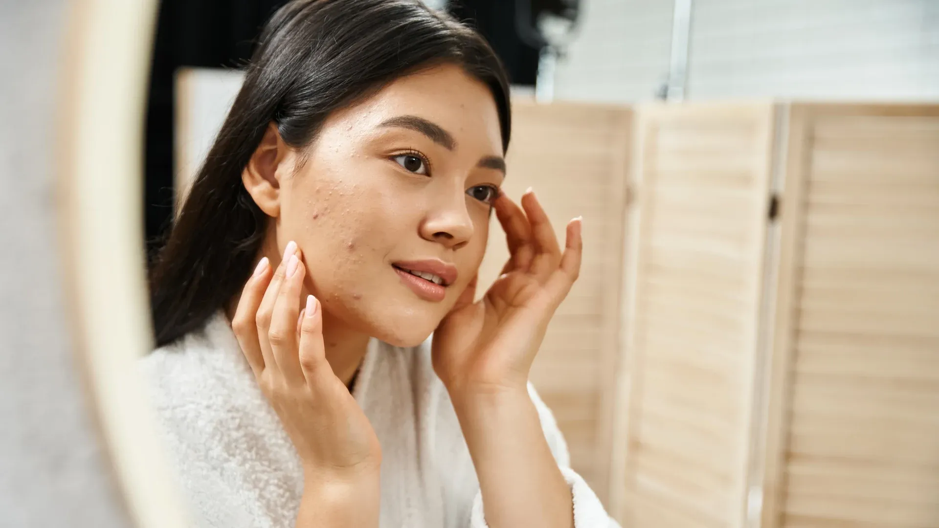 5 Melhores pomadas para acne em 2025